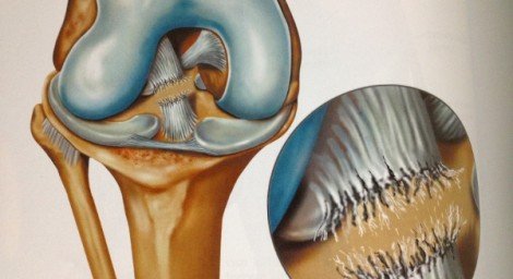 Lesión de Ligamento Cruzado Anterior | Dr. Aurelio Martinez