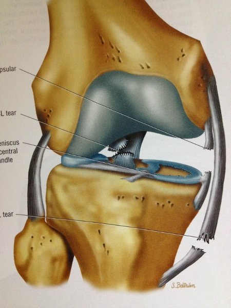 Lesión de Ligamento Cruzado Anterior | Dr. Aurelio Martinez