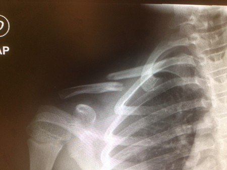 Boletín 79: Fracturas de Clavícula | Dr. Aurelio Martinez